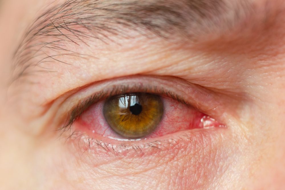 Uveitis vs Conjunctivitis | Banton Frameworks