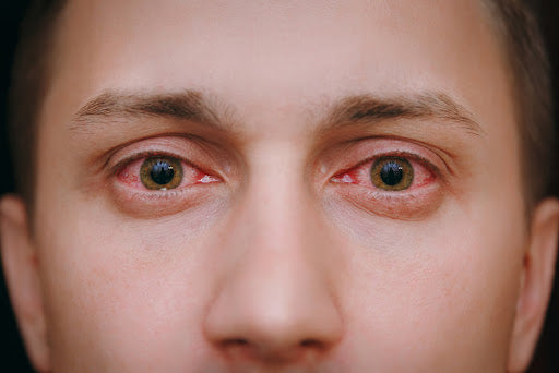What Causes Sticky Eyes| Banton Frameworks